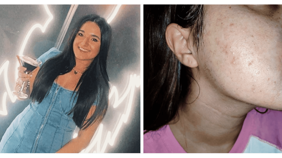 'I spent hundreds to remove excess hair after waiting seven years for a ...
