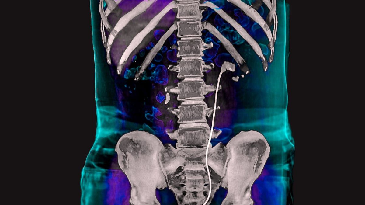 Horrifying 'scromiting' side effect of cannabis use that is 'hard to treat'