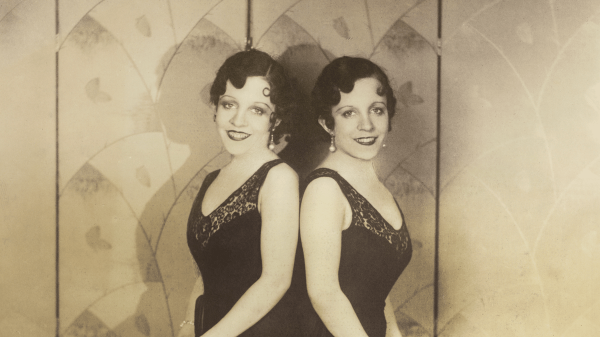 Disturbing case of conjoined twin who was forced to live with dead ...