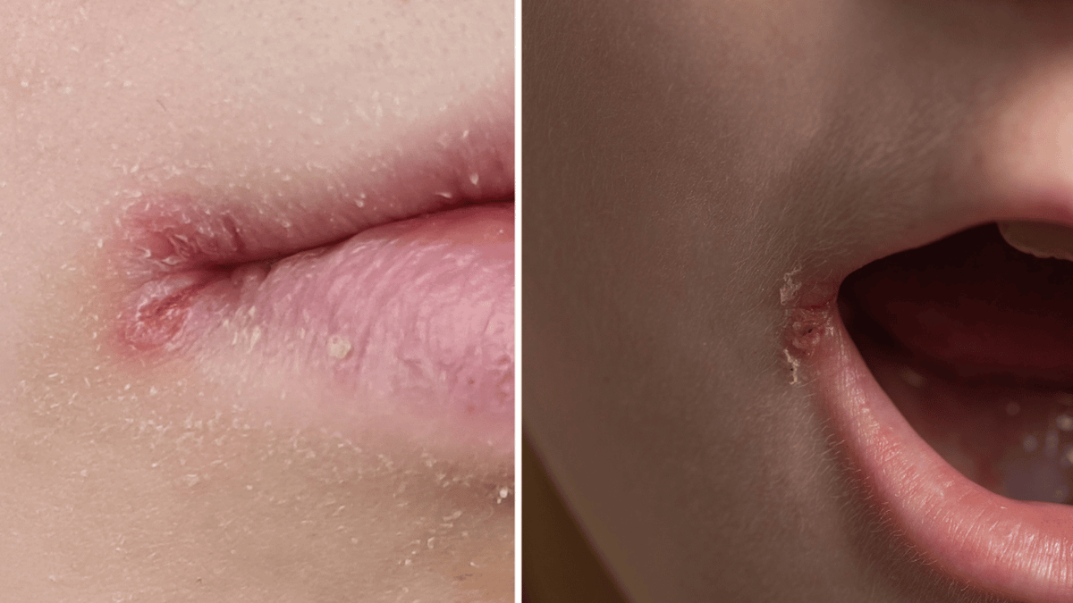 Warning issued to anyone who thinks they have ‘chapped lips’ as the ...