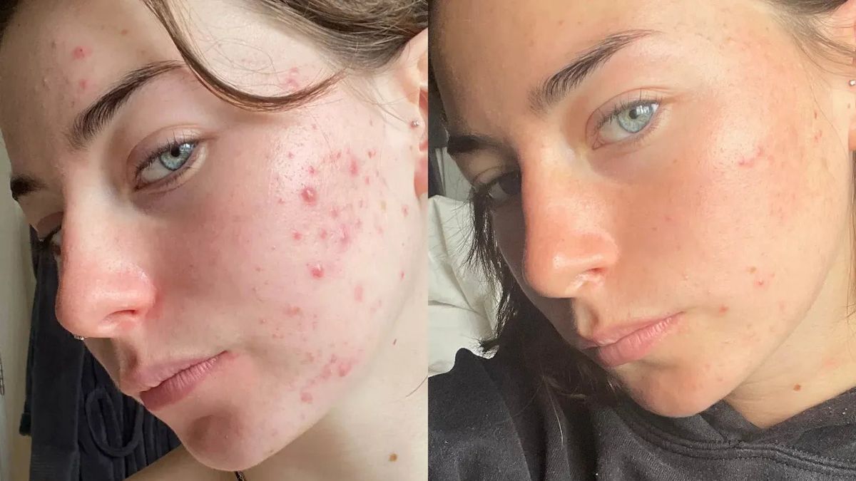 Women say 'game-changing' face mask can 'clear up acne in four weeks'