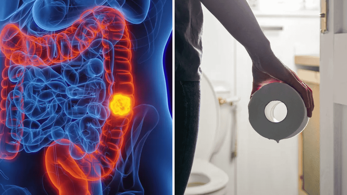 Doctor reveals crucial colon cancer self-check as cases surge for ...
