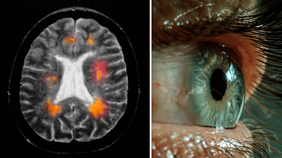 Early sign of MS to look out for that could appear in your eyes