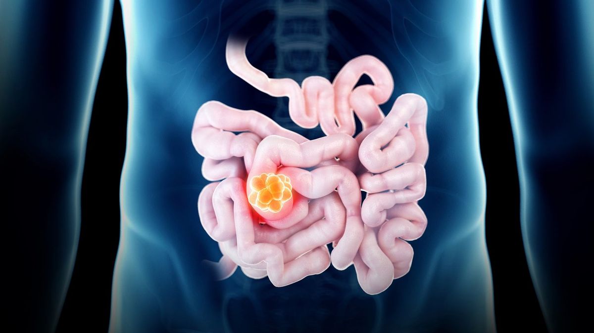 Doctor Issues Warning Over Pain Free Bowel Cancer Symptoms As Cases