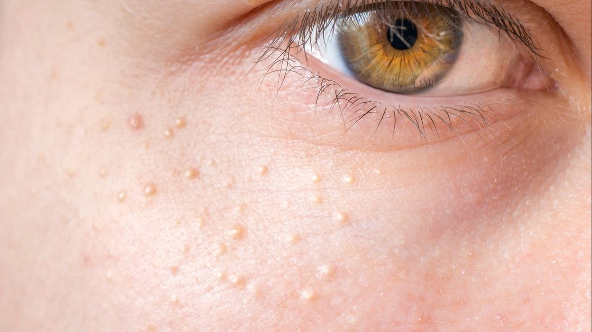 What those strange white bumps on your body actually are as private ...