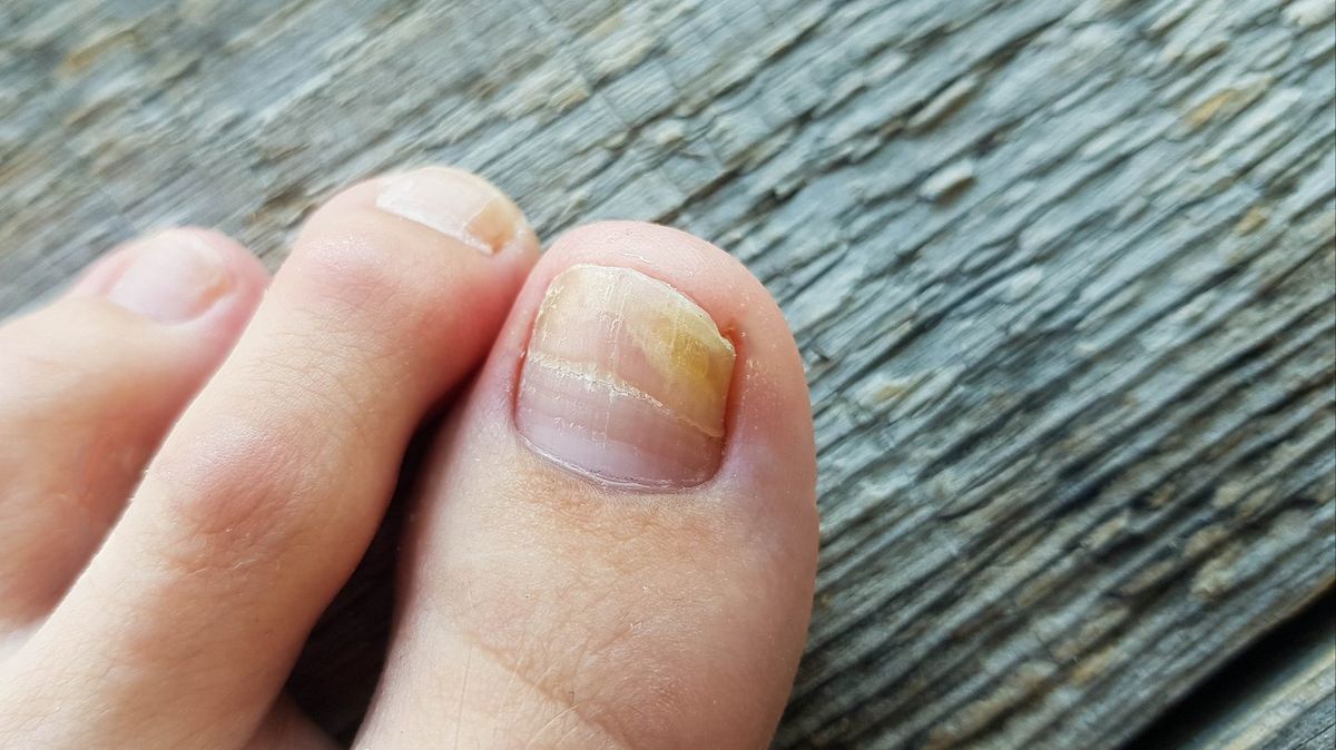 Podiatrist warns anyone with discoloured toenails should see doctor ...