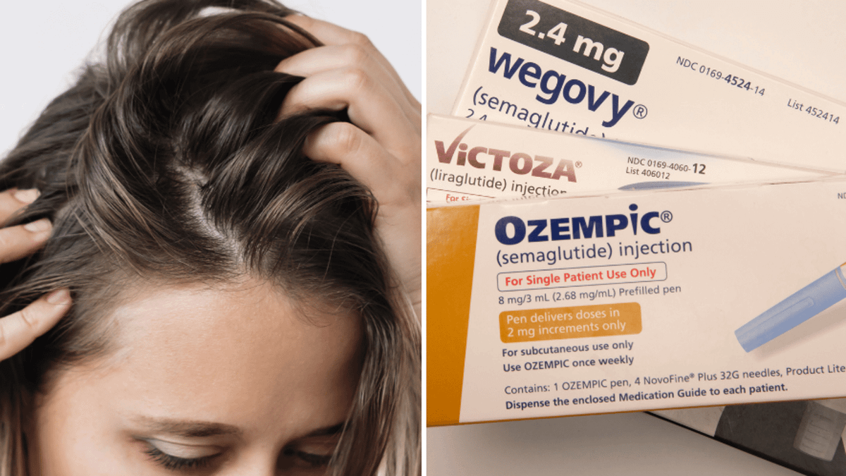 Doctors issue serious warning on 'Ozempic scalp' as people report ...