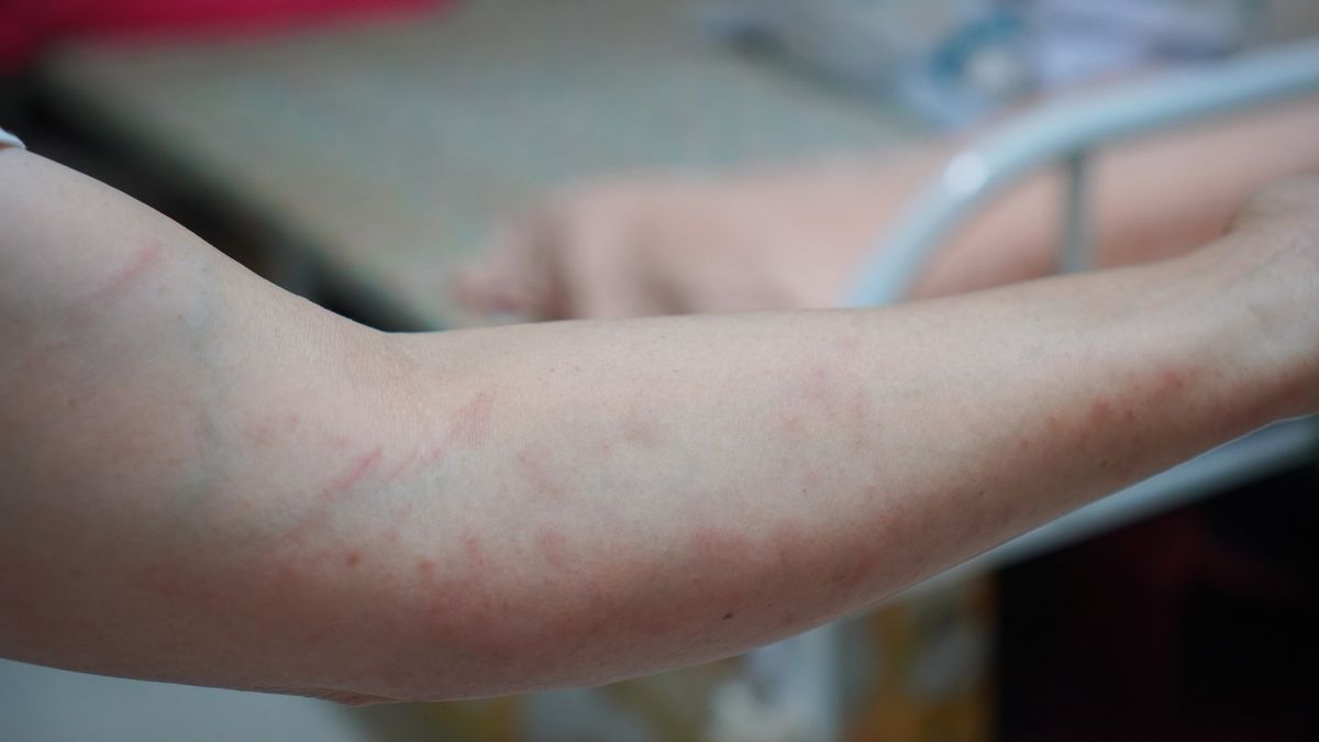 Rare illness spreading across US that causes meat allergy has sparked ...