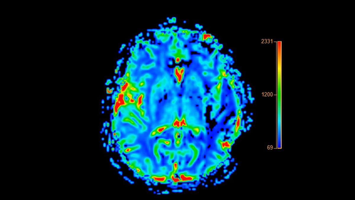 Scientists discover hidden ‘death complex’ that could drive Alzheimer’s ...