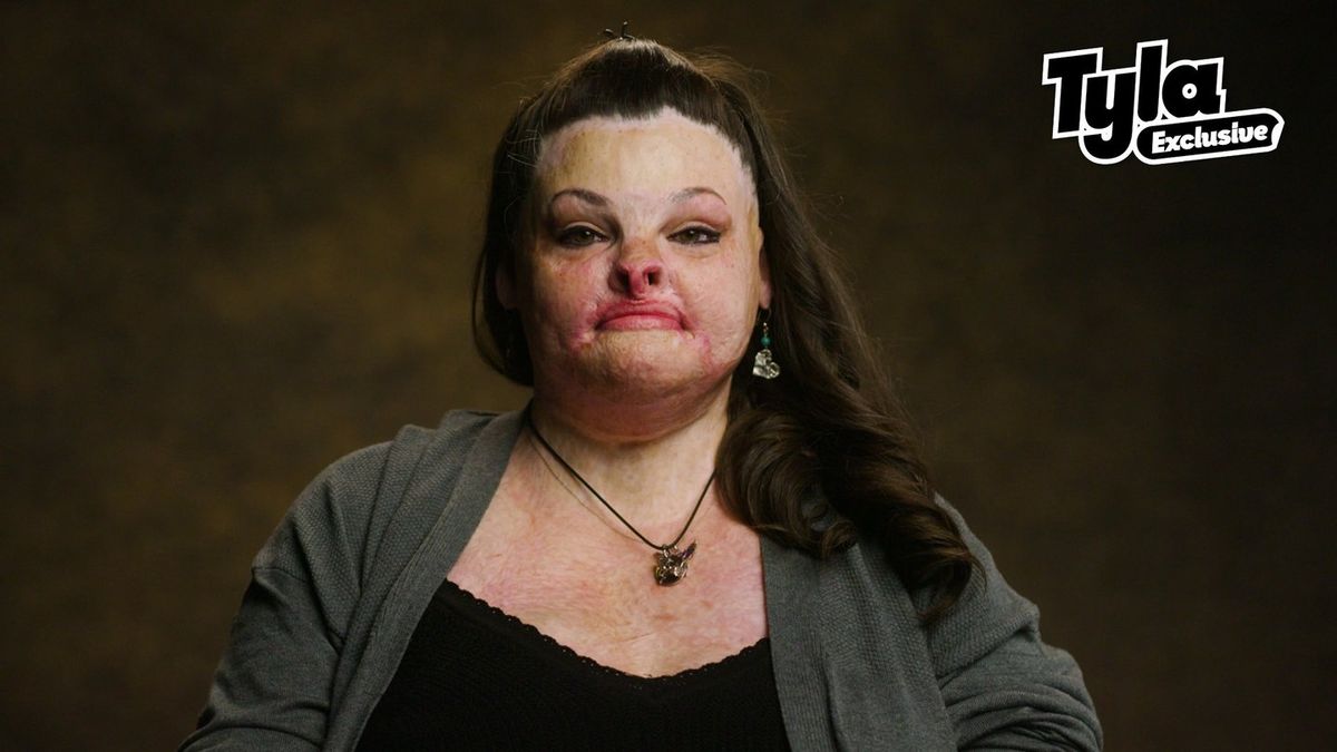Former addict who set herself on fire was so badly burned she ‘lost her ...