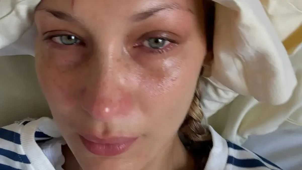 Bella Hadid shares sad reality of battling with disease common among ...