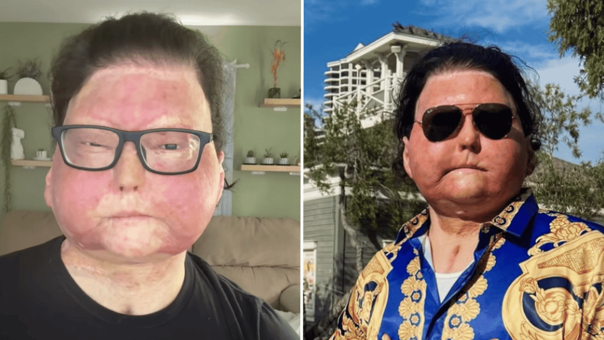 Man who received 47-year-old donor’s face reveals one surprising ...