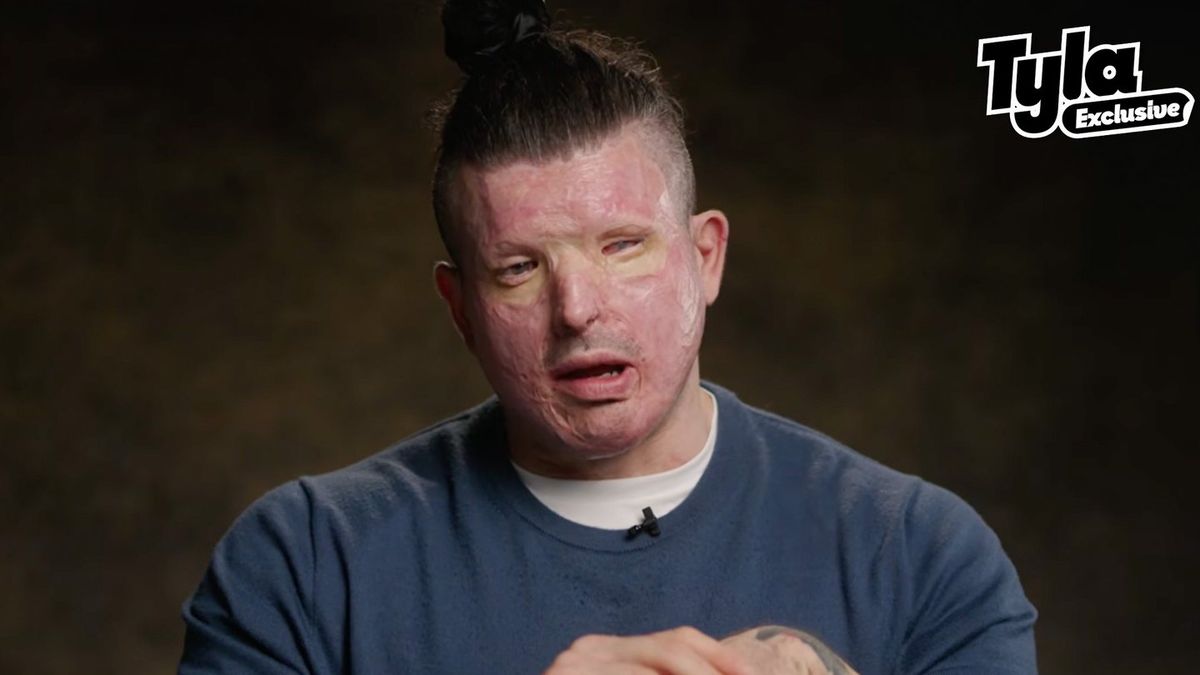 Baby's devastating reaction to seeing dad for first time after acid attack