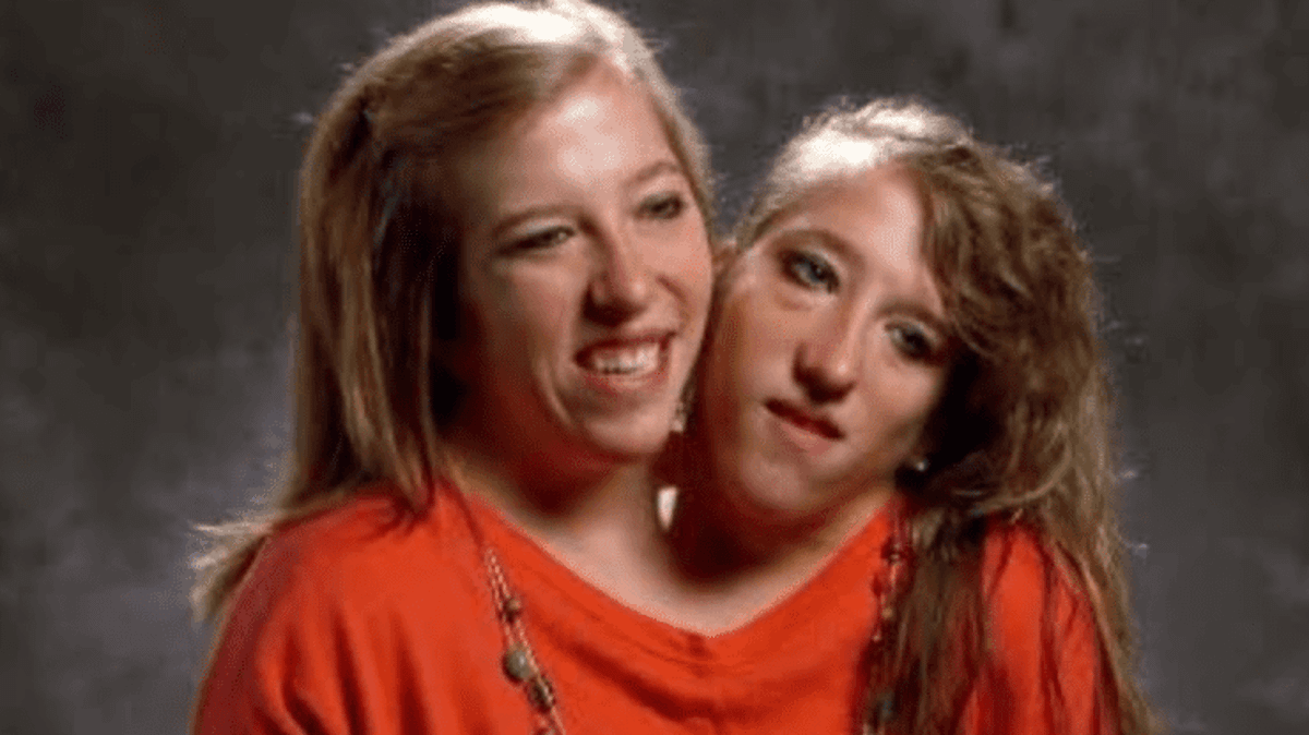 Expert reveals who would be the mother as conjoined twins Abby and ...