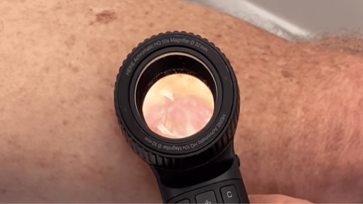 Doctor shares shocking video of 'worst' skin cancer he's ever seen and ...