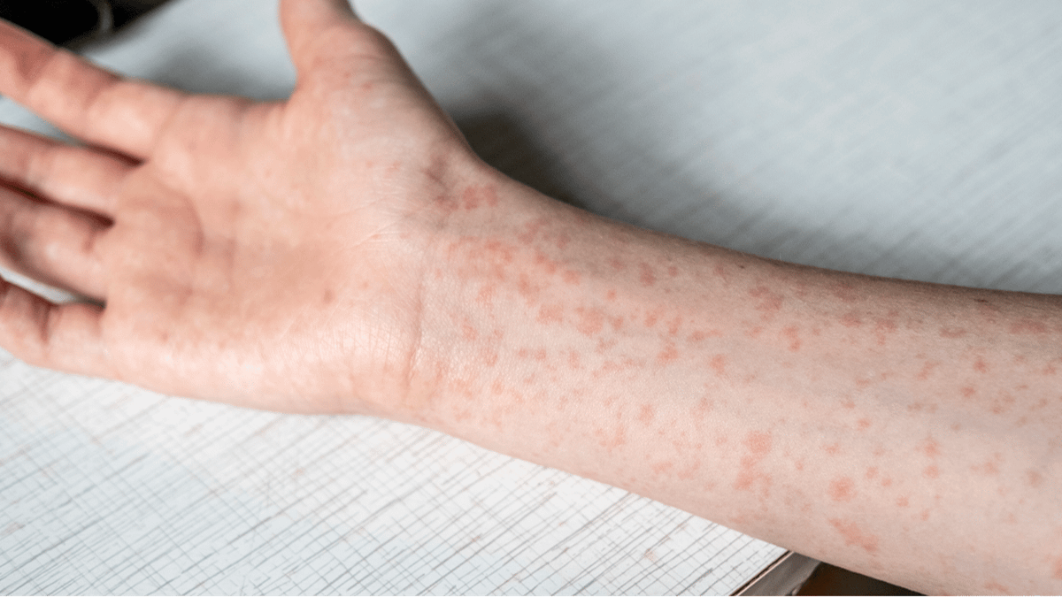 Health officials release shocking update after major measles outbreak ...