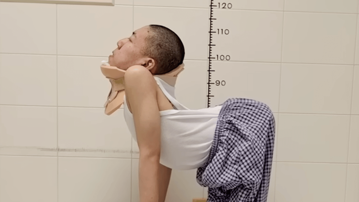 ‘Folded boy’ stands up straight for the first time after spine was ...