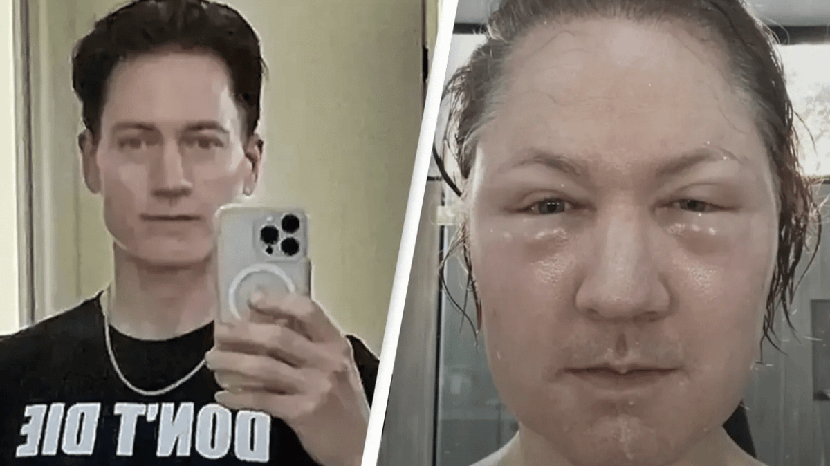 Biohacker who is 'reverse aging' reveals horrifying side-effect of ...