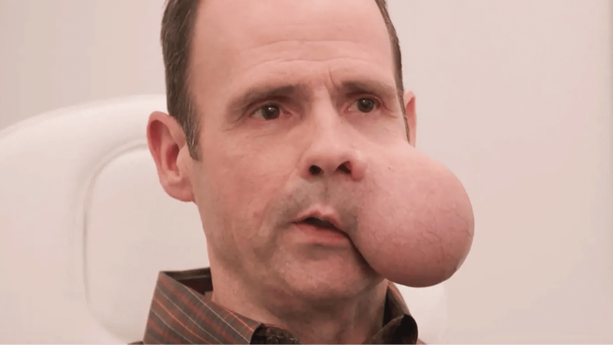 Man with 4-pound tumor on his face pleads for help as doctors issue ...