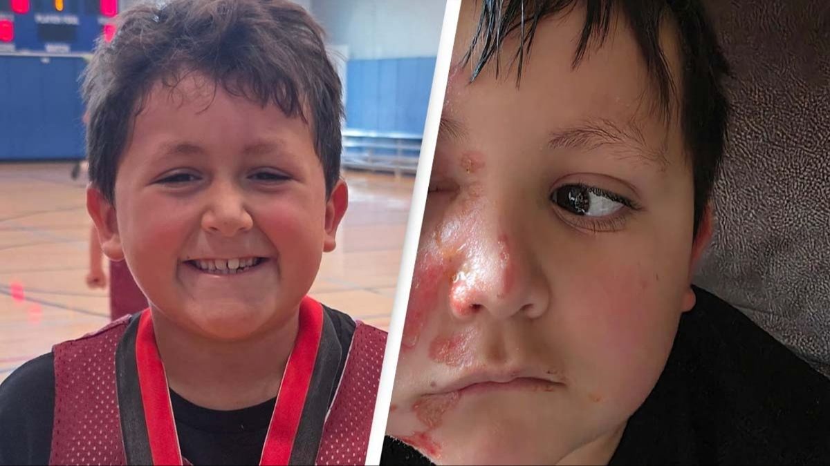 9-year-old boy left with terrifying facial burns as shocking social ...