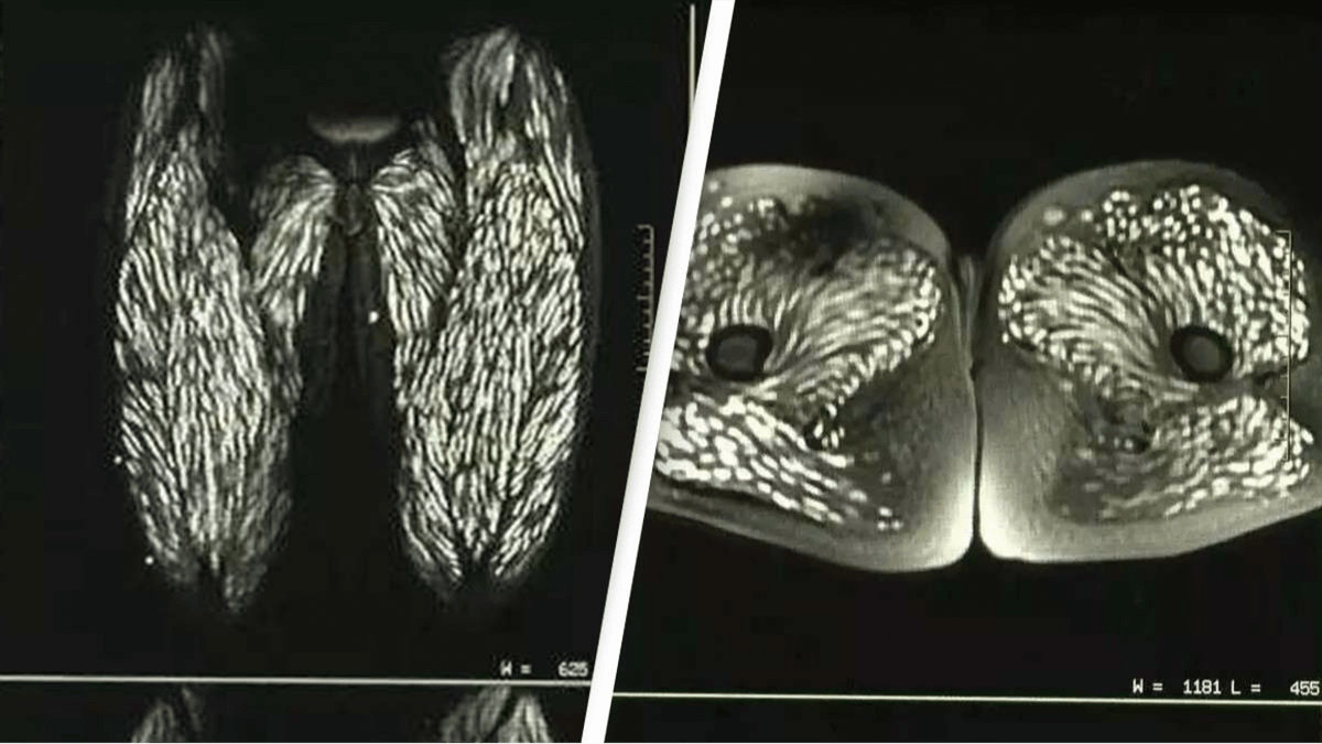 Horrifying scans show parasite-infested body of woman who'd been eating ...