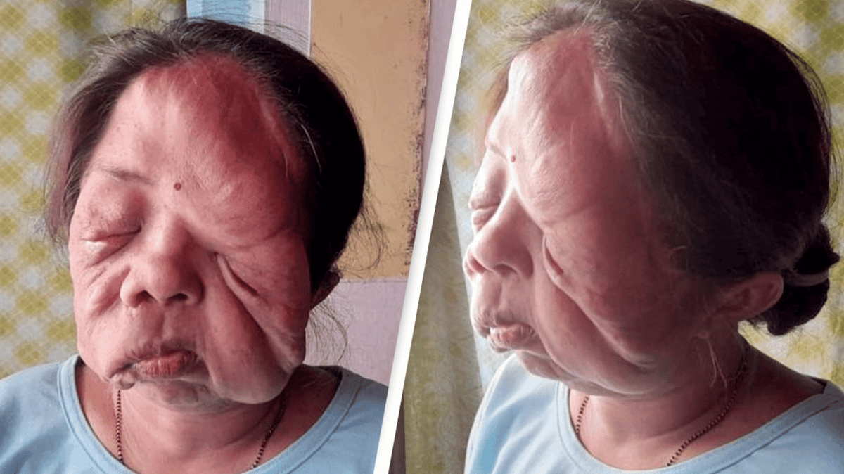 Woman whose face is 'melting off' her head speaks out about living with ...