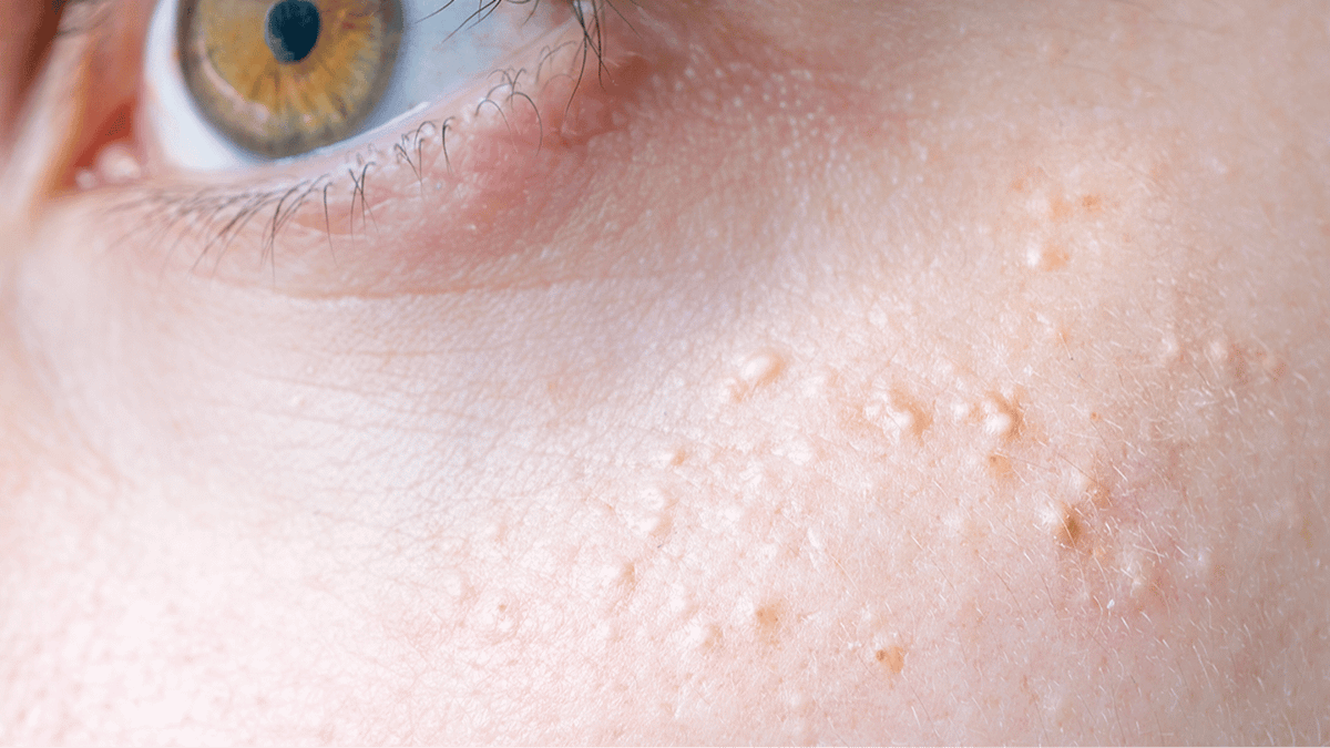 Reason behind series of white spots on your body and private parts as ...