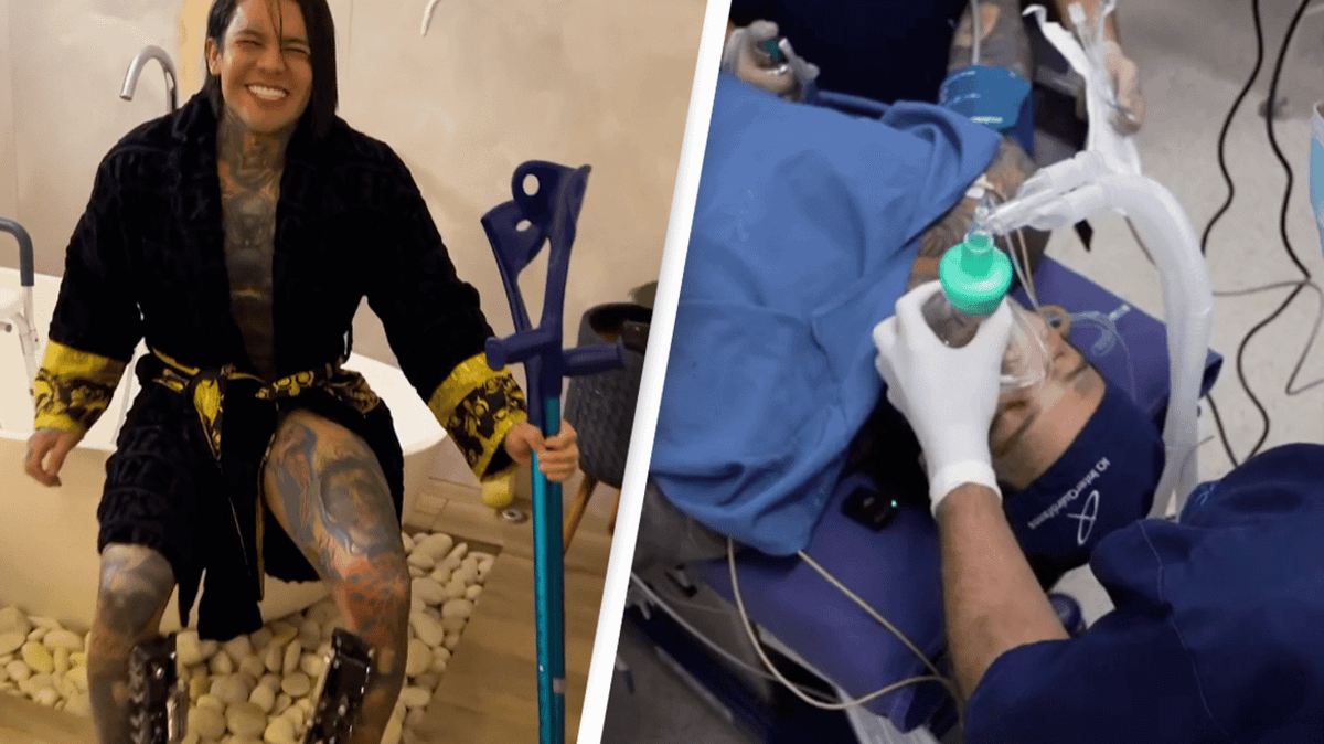 Man explains why he spent $175,000 on ‘most painful’ leg lengthening ...