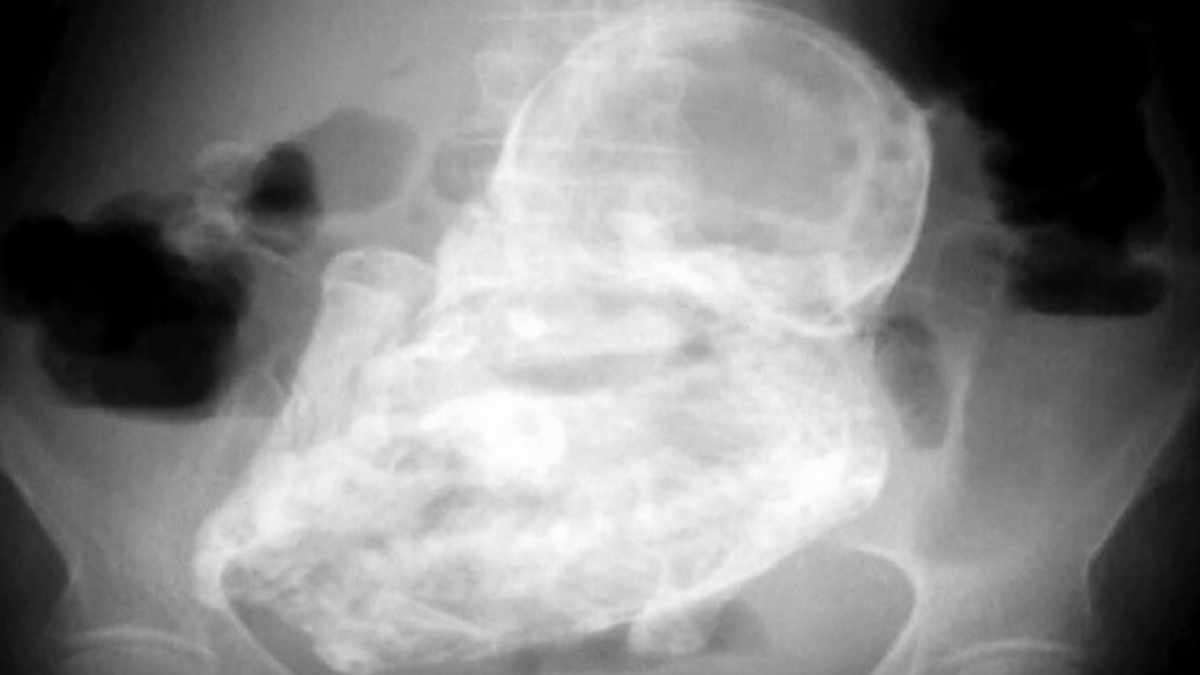 40-year-old 'stone baby' was found in the womb of elderly woman after ...