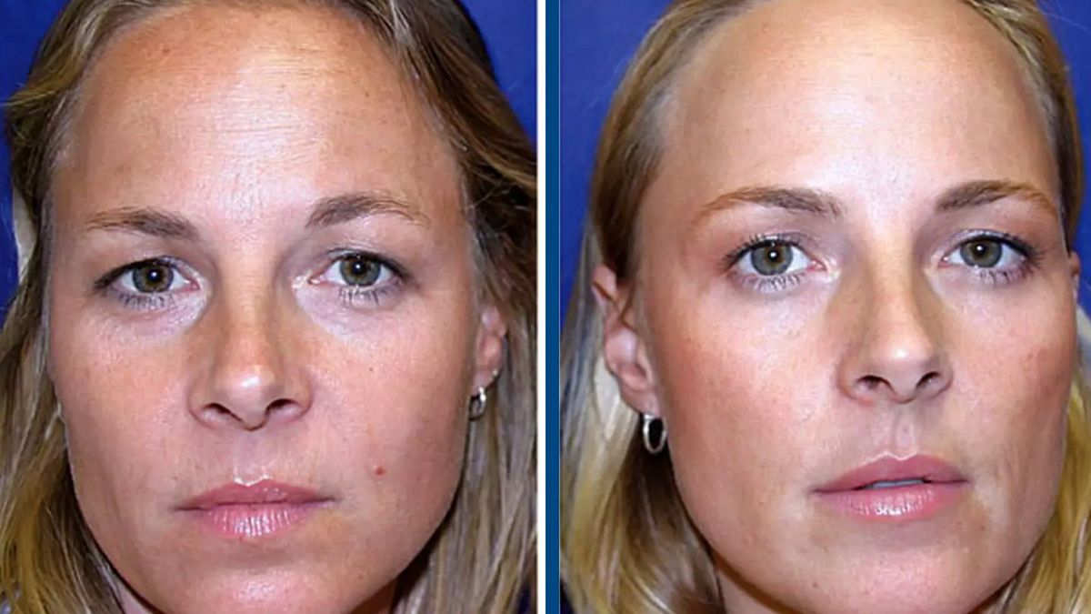 Identical twins share astounding results after one used Botox for 20 ...