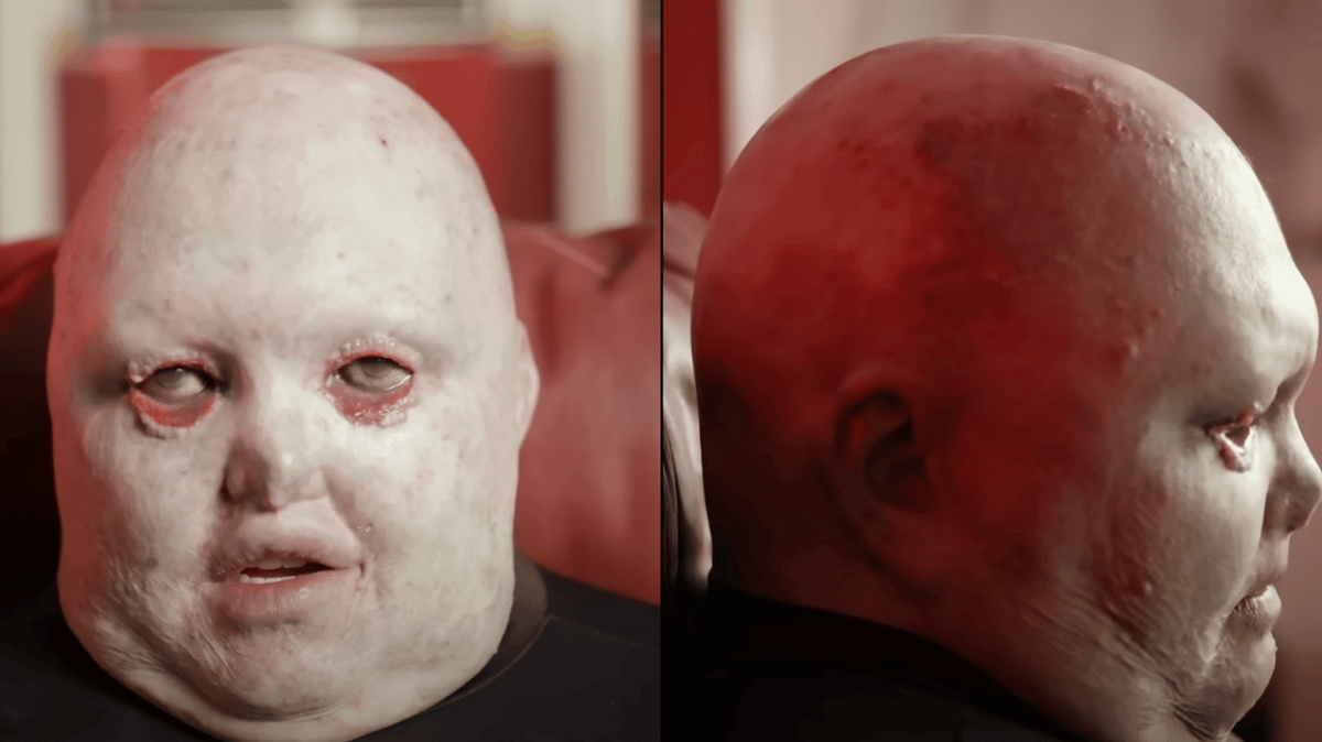 Man in constant pain due to rare condition that should have killed him ...