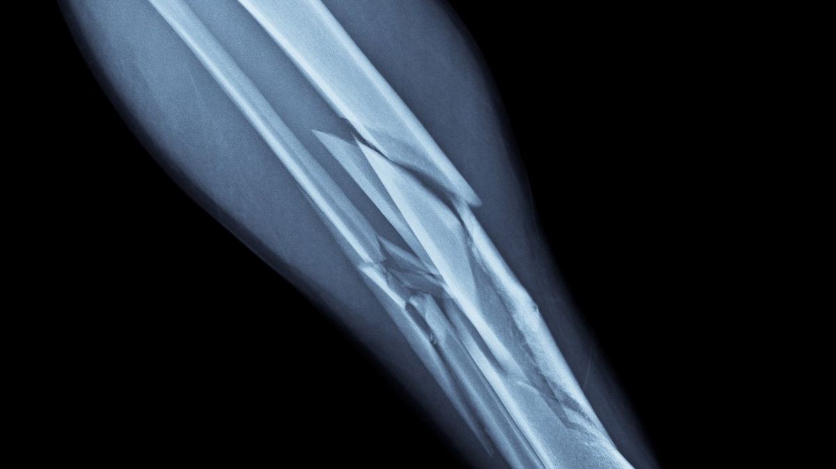 What happens if you break a bone as an adult vs as a kid as strange ...