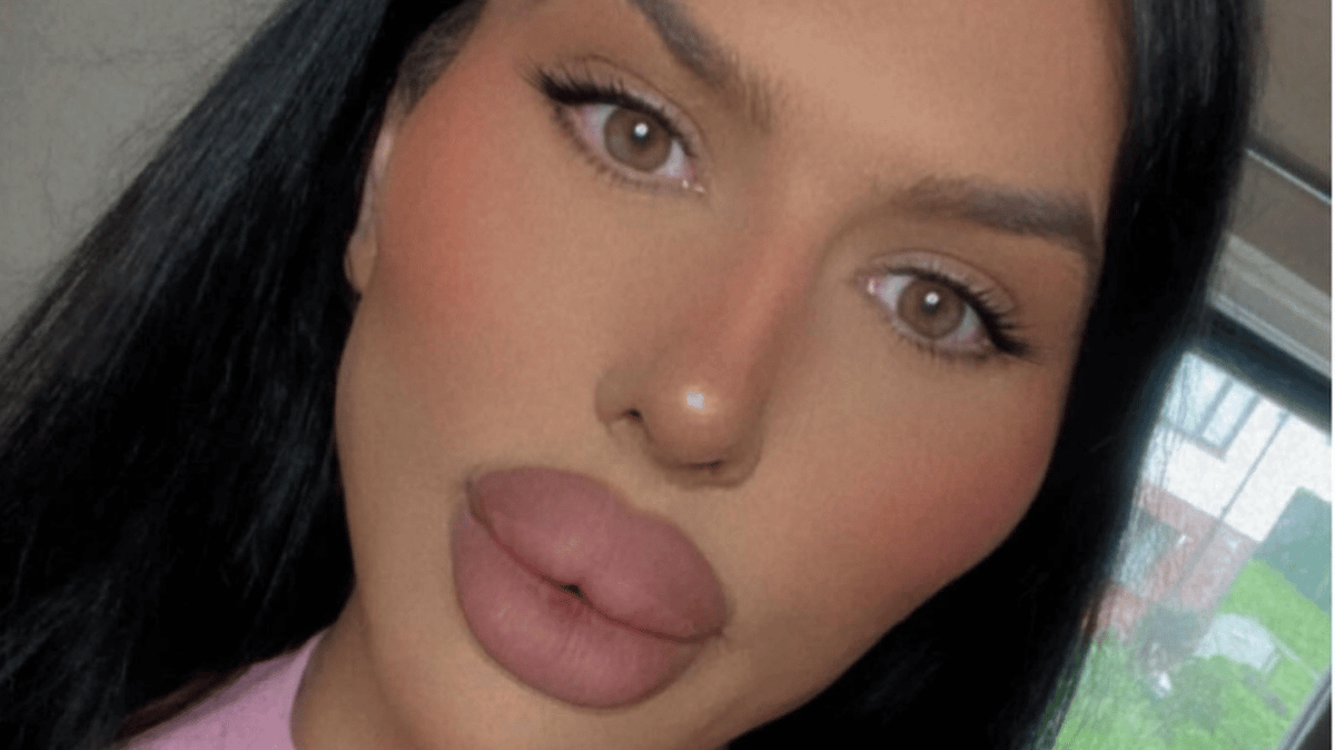 Woman with ‘UK’s biggest lips’ has filler dissolved to show off difference