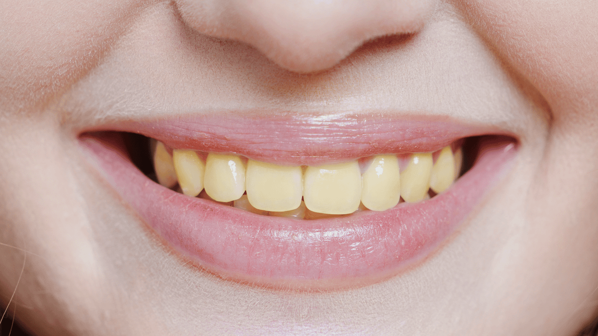 Dentist reveals why your teeth are yellow even though you brush them daily