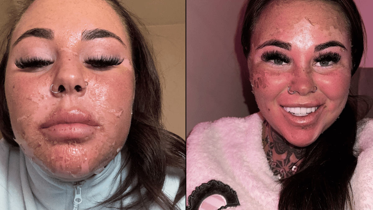 Influencer left horrified after accidentally burning skin off face ...