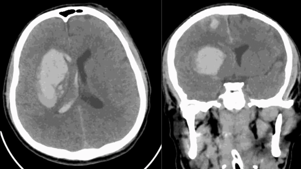 Doctors issue fresh warning over killer fungal infection posing a ...