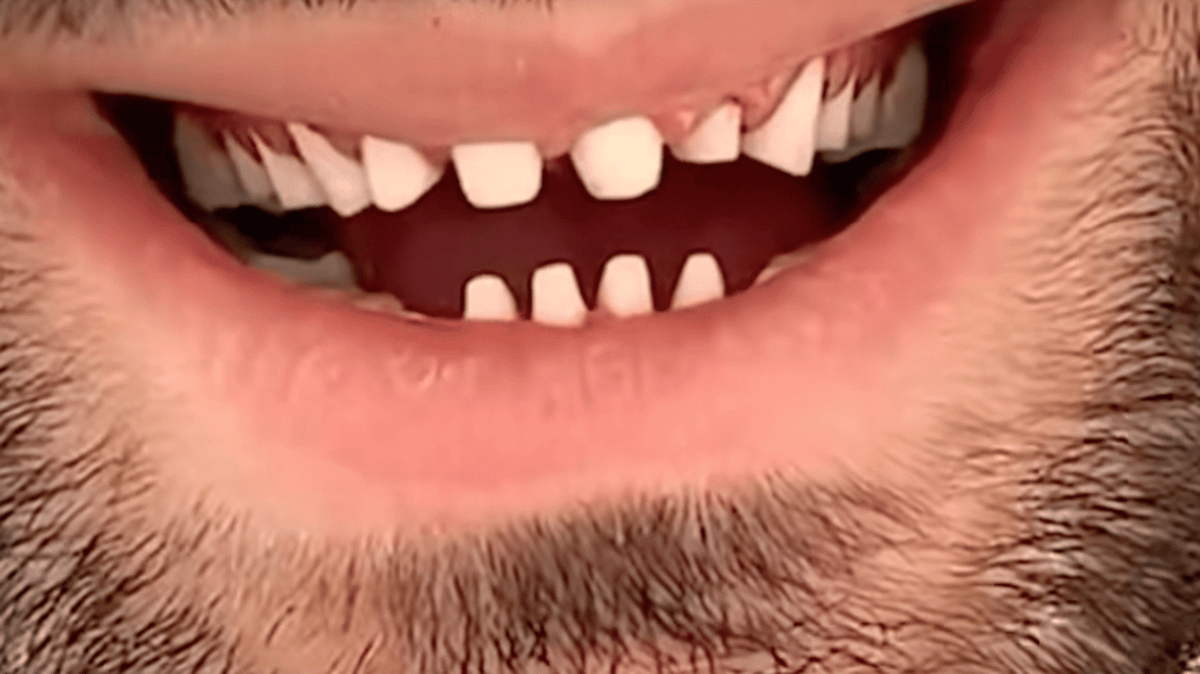 Dentist exposes the dark side of people going for 'Turkey teeth'