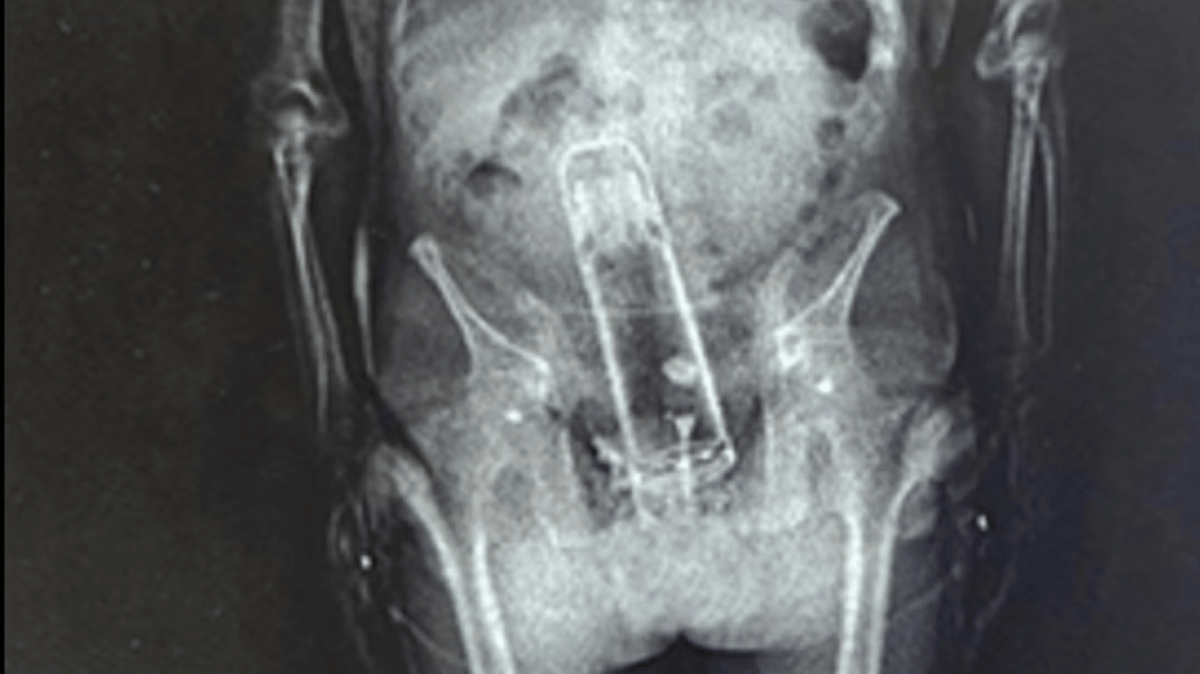 Shocking X-ray shows how Florida man managed to lodge Thermos flask up ...