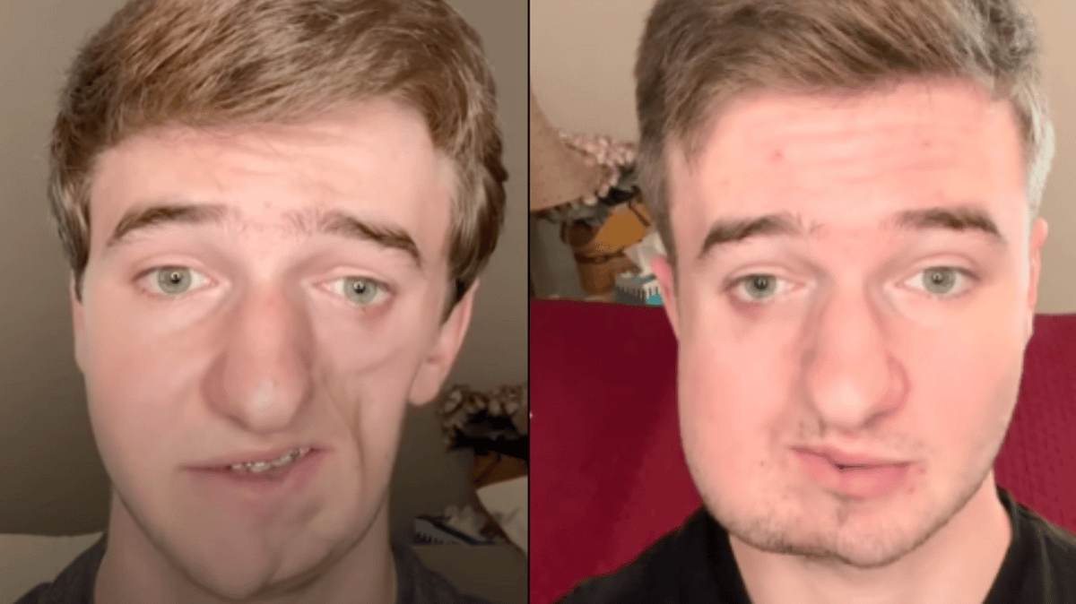 Man living with rare condition that causes one half of face to shrink ...