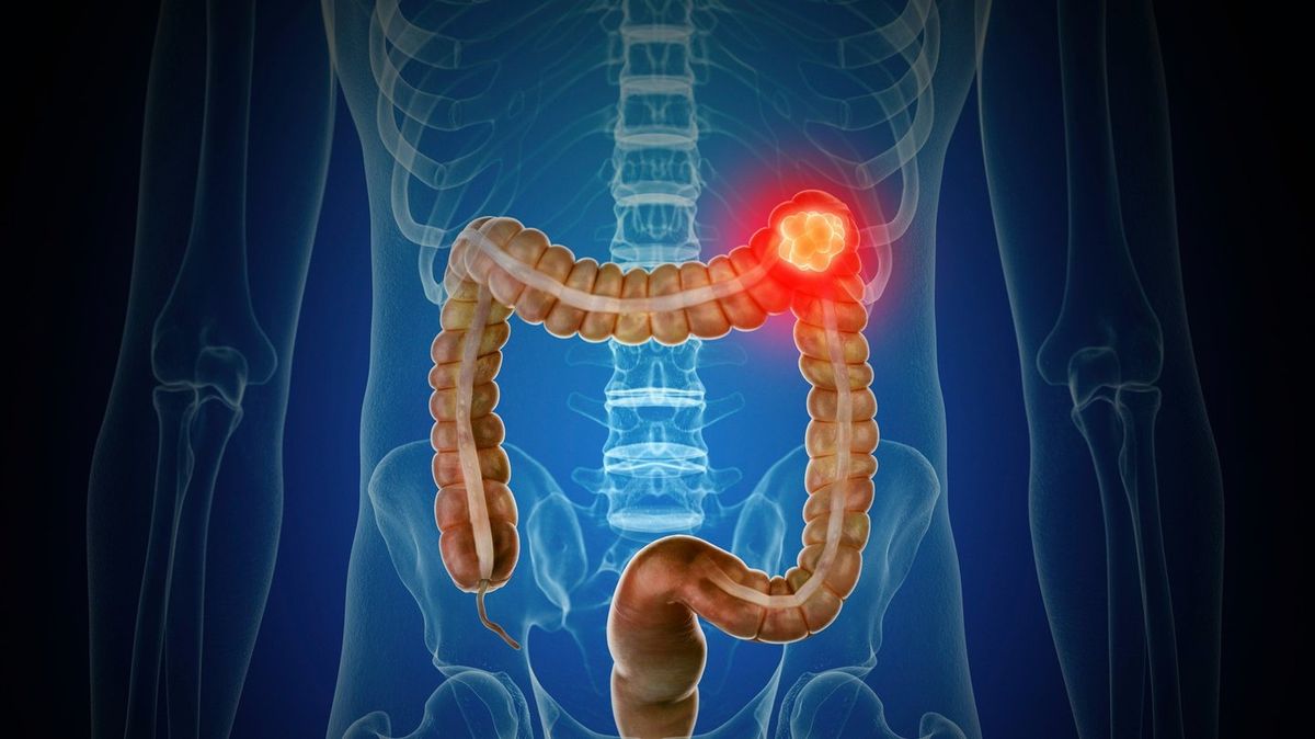 'Subtle' signs of colorectal cancer as it becomes biggest killer of ...