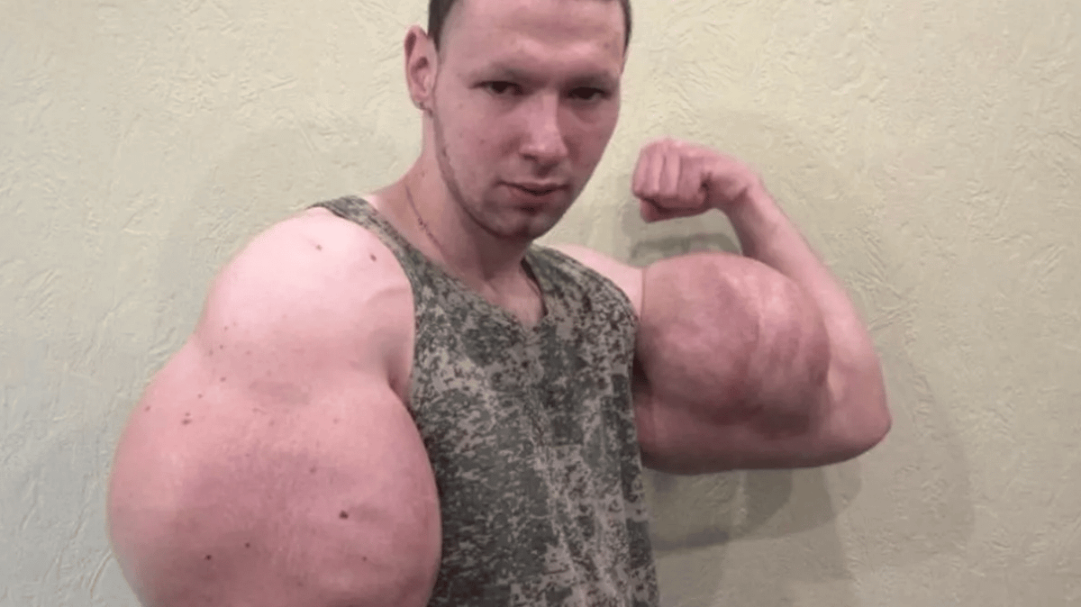 'Russian Popeye' who injected oil into biceps hospitalised after ...
