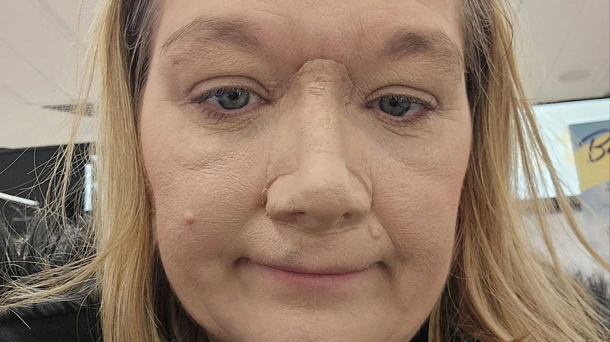 Woman left with no nose after thinking nose bleeds were due to ‘hay fever’