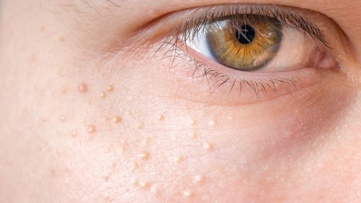 Doctor explains how to get rid of small white spots that appear all ...