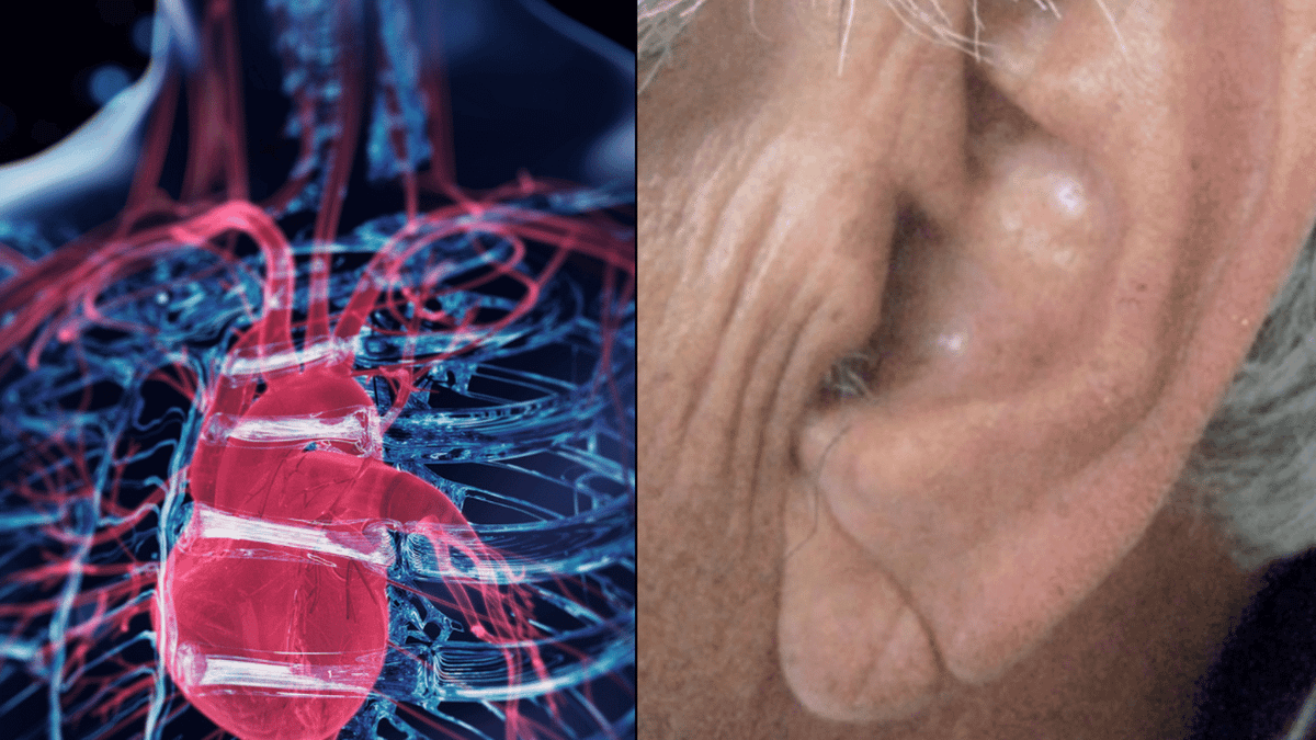 Some people have a distinct mark on their earlobe that can be a sign of ...
